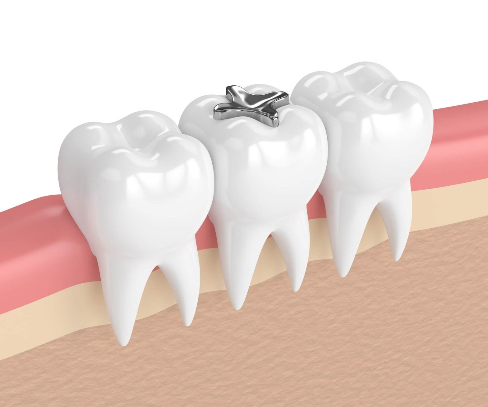 Eric Davis Dental - Mercury Doesn’t Just Stay in The Mouth