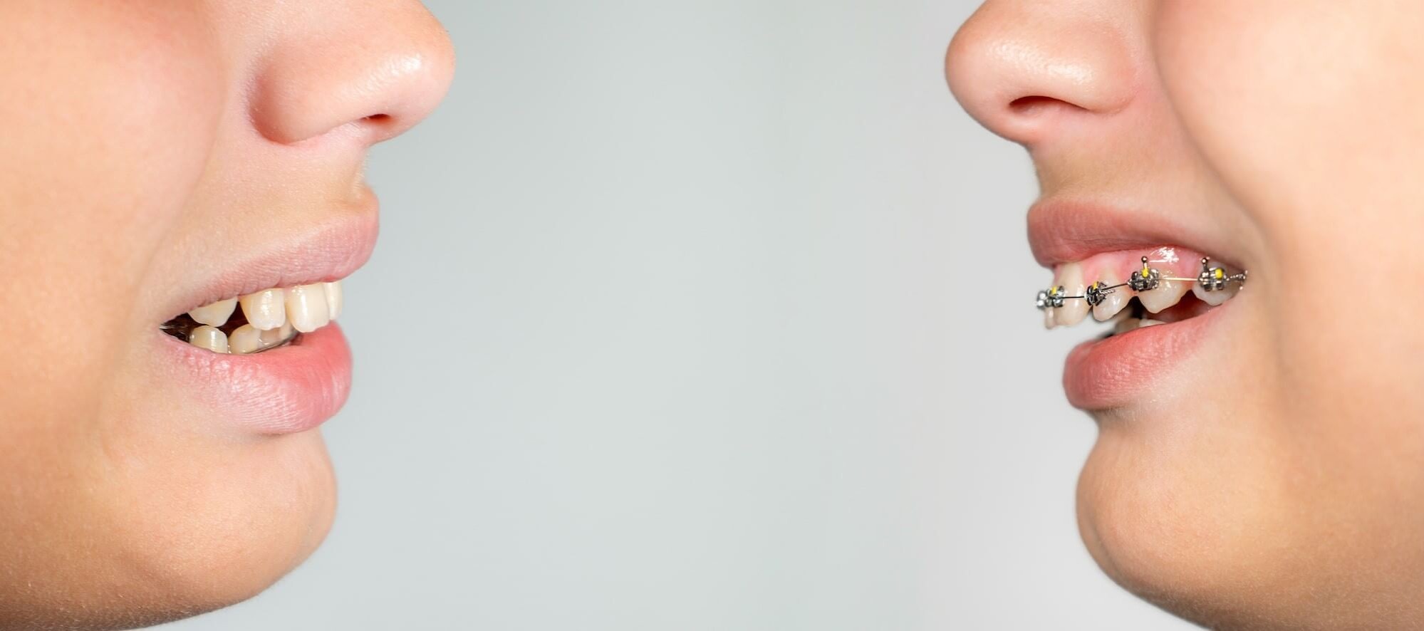 Eric Davis Dental - mouth breathing and how it causes malocclusion